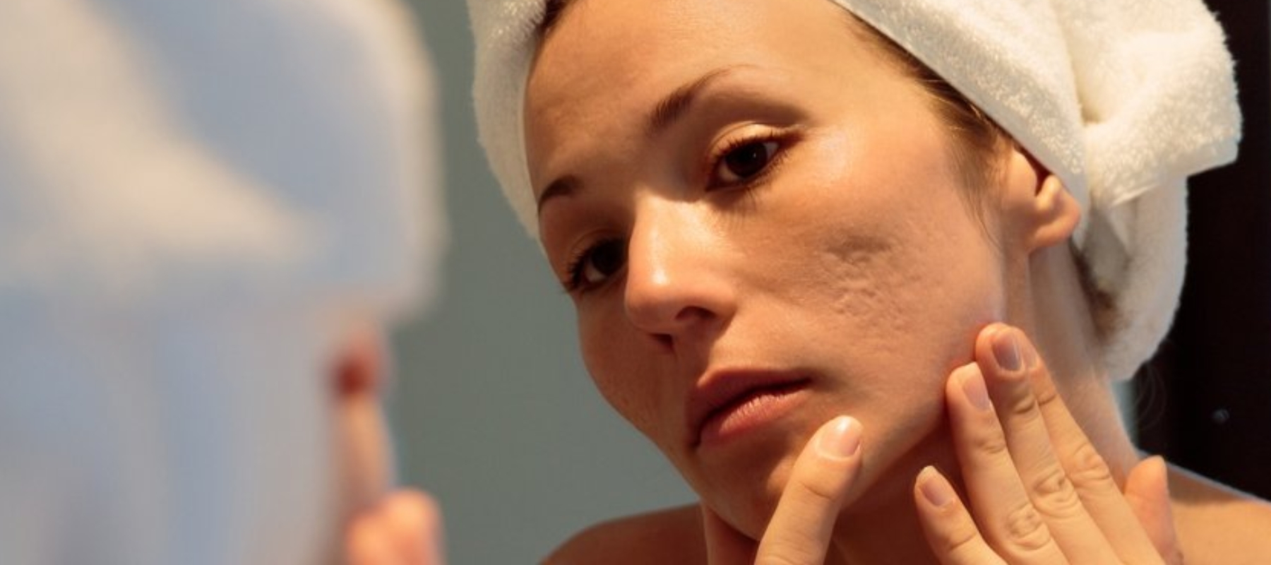 Acné adulte : d'où vient-elle, et comment l'éliminer