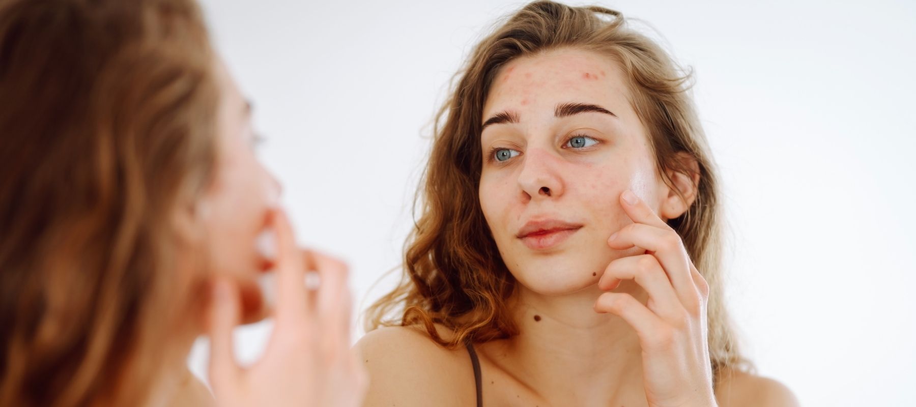 Peau acnéique : est-elle forcément liée à une peau grasse