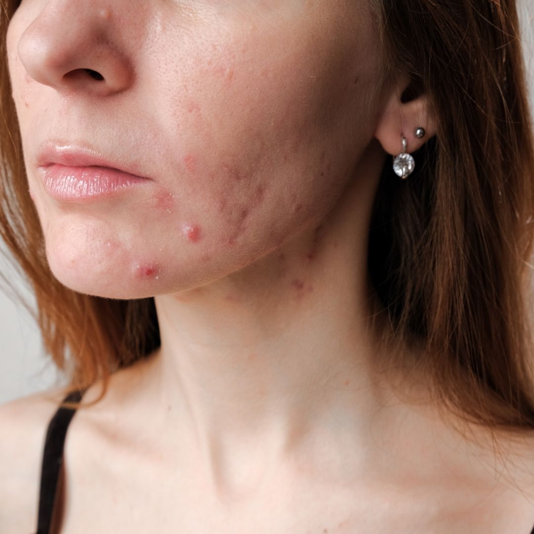 Comprendre l’acné : types, causes et traitements