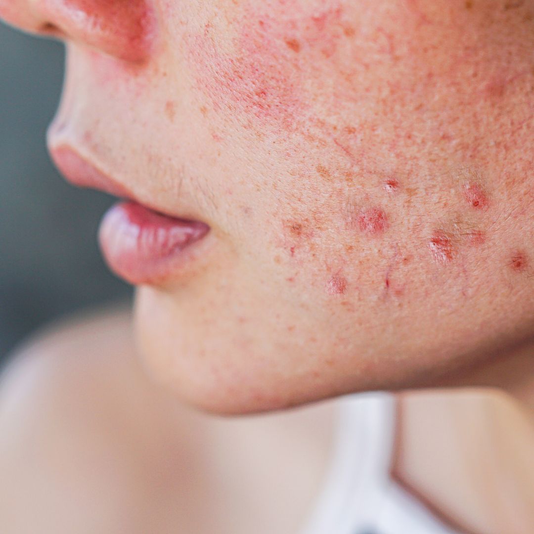 Comprendre l’acné : types, causes et traitements