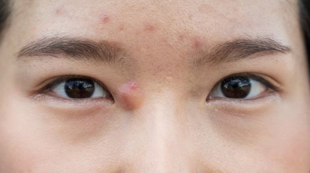 Comment se débarrasser des boutons sur le visage