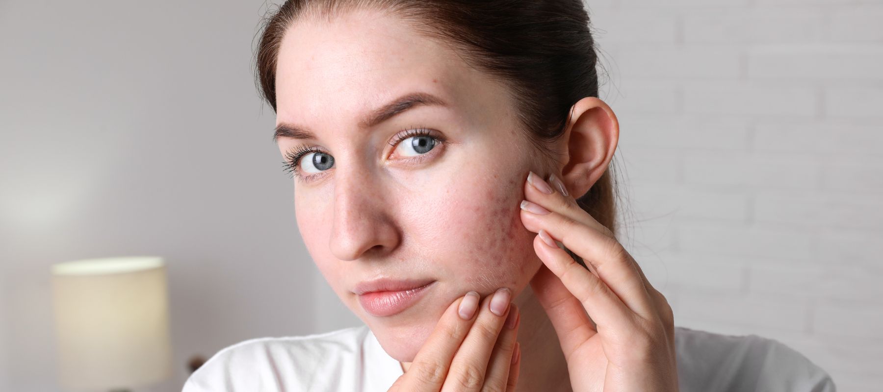 Les boutons d'acné : Quels sont les différents types