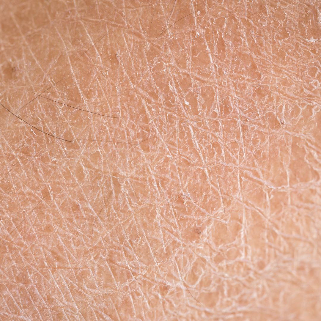 Xérose et sécheresse cutanée : symptômes, causes et soins de la peau ...
