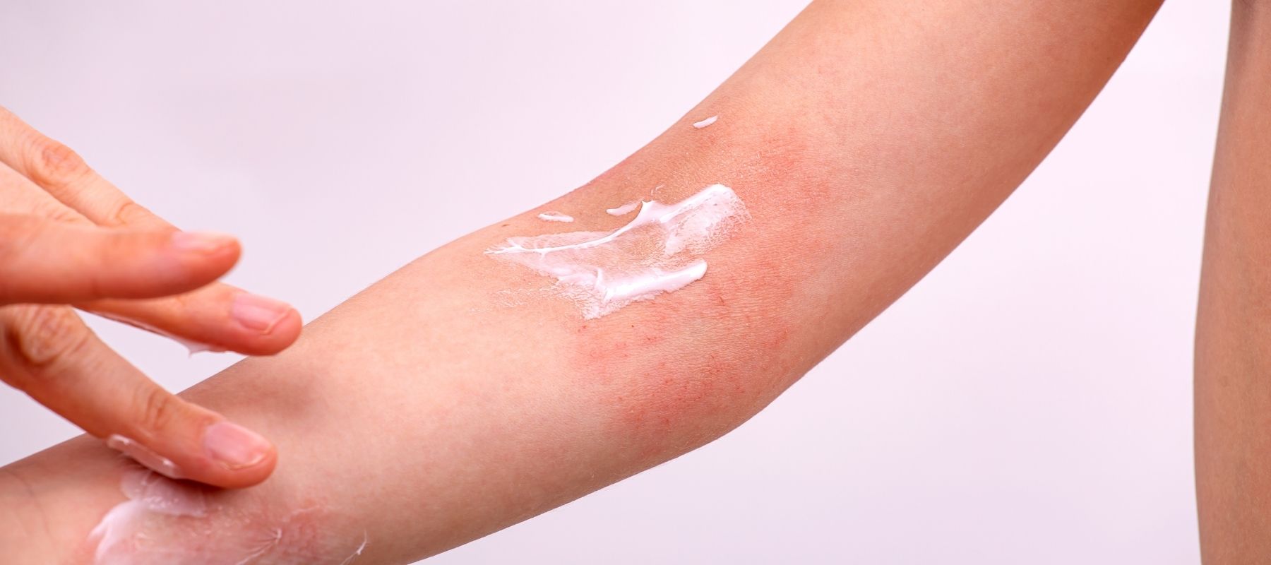Eczéma ou dermatite atopique : symptômes, causes et traitements ...