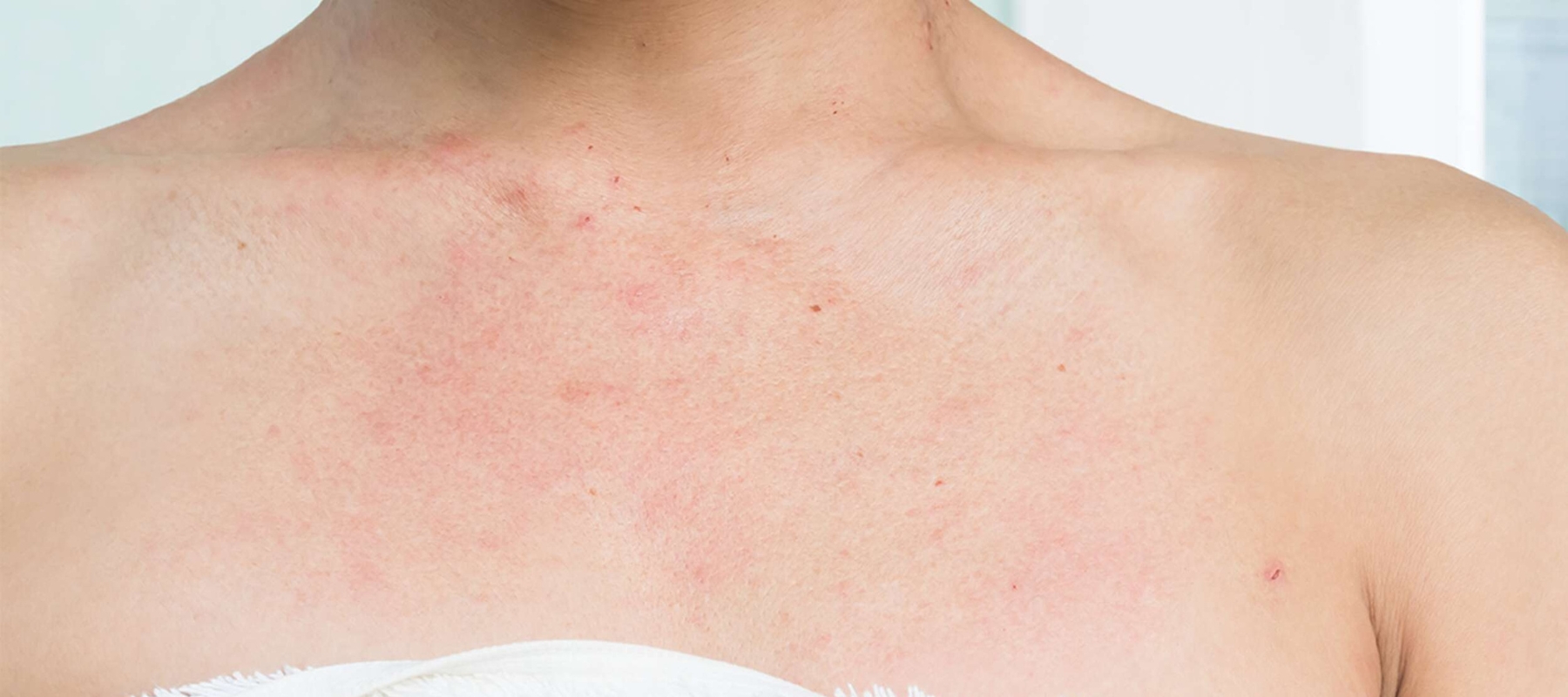 Peau atopique, eczéma : Quel traitement et gestes d'hygiène ...