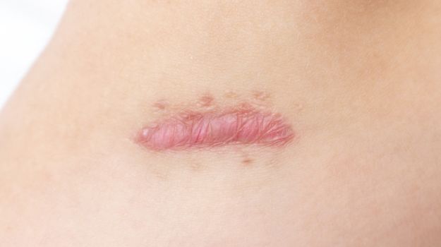 Cicatrices : mieux les comprendre pour mieux les soigner | BIODERMA France